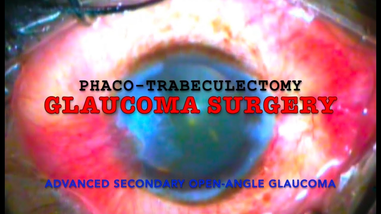MIIQ 23: Glaucoma Surgery || Phaco-Trabeculectomy || Corneal Scar || DR ...