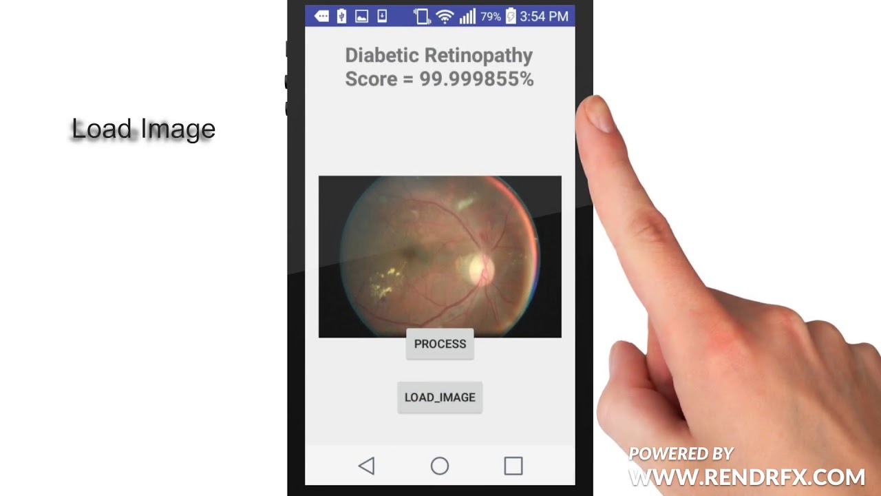Android App for Diabetic Retinopathy Detection - YouTube