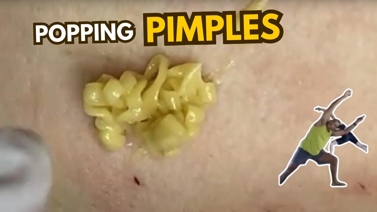 popping pimples, amazing and satisfying - YouTube