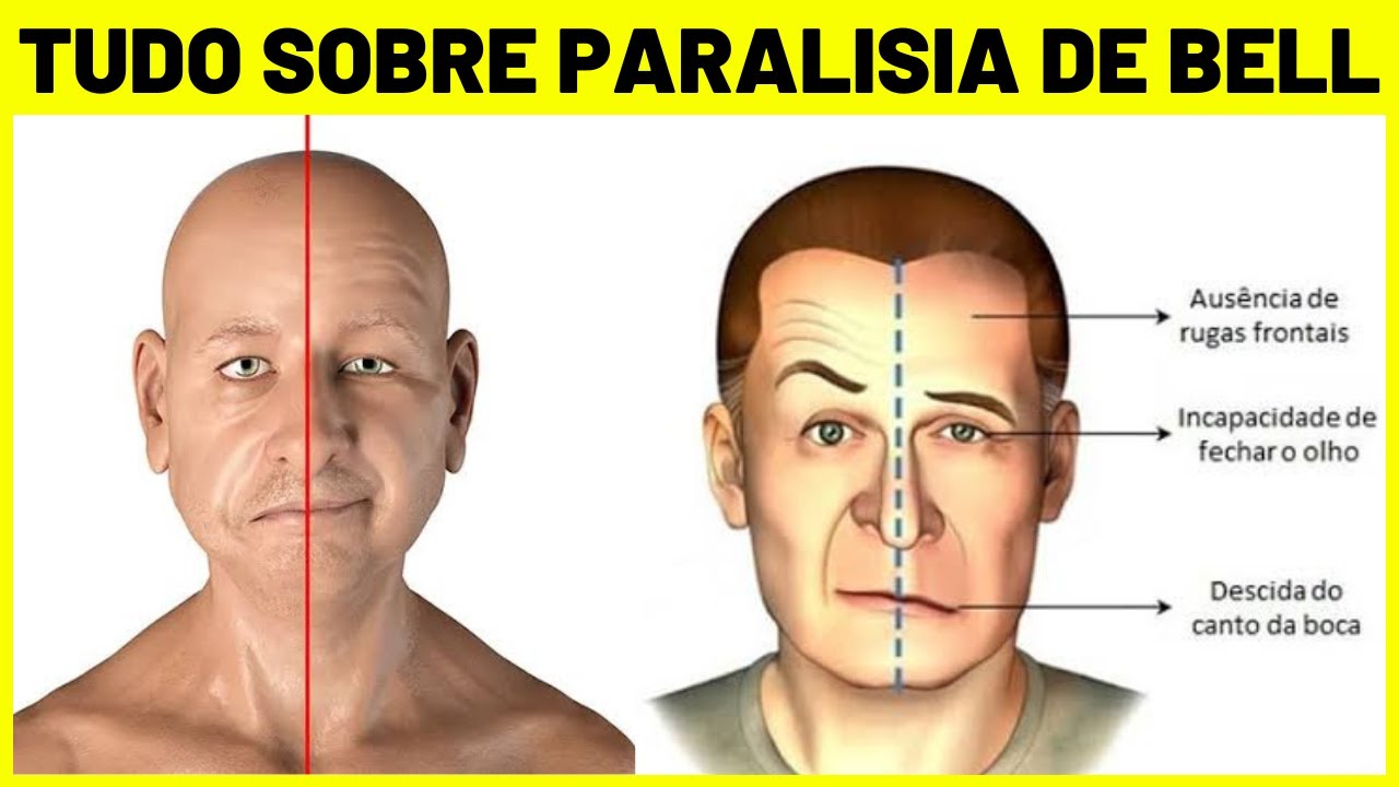 PARALISIA DE BELL - O QUE É, CAUSAS, SINTOMAS E TRATAMENTO (paralisia ...