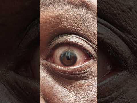 Snapped back up top!! Mucus Eye Fishing Syndrome Eye Gunk Removal - YouTube