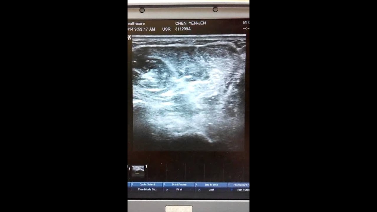 Sono-guided botulinum toxin injection into pronator teres in a stroke ...