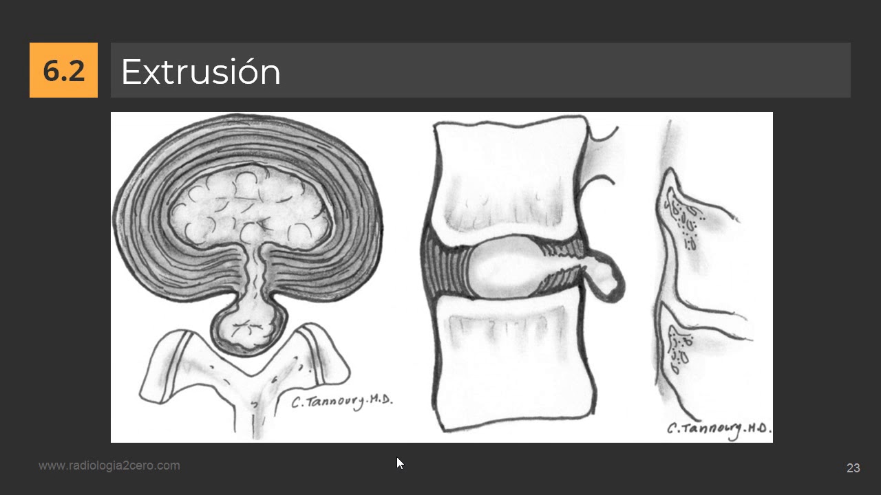 Cómo describir la Patologia Discal - YouTube