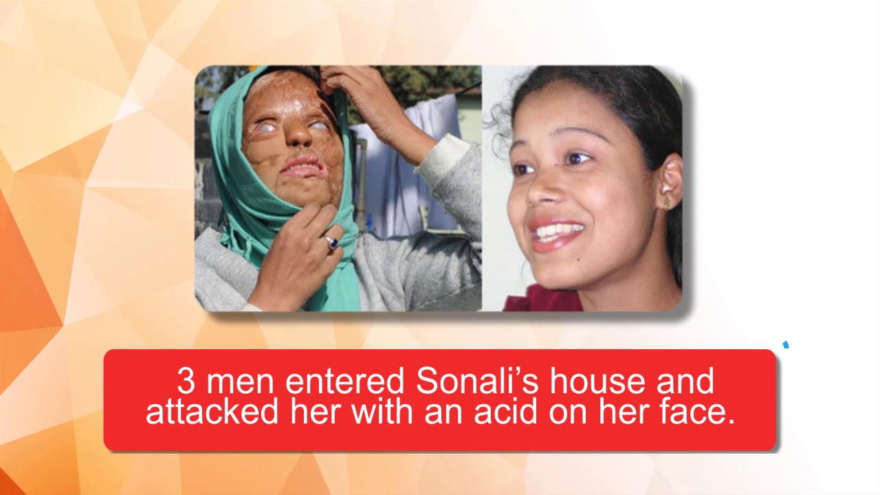 Acid Attack Victims and their Survival Story - YouTube