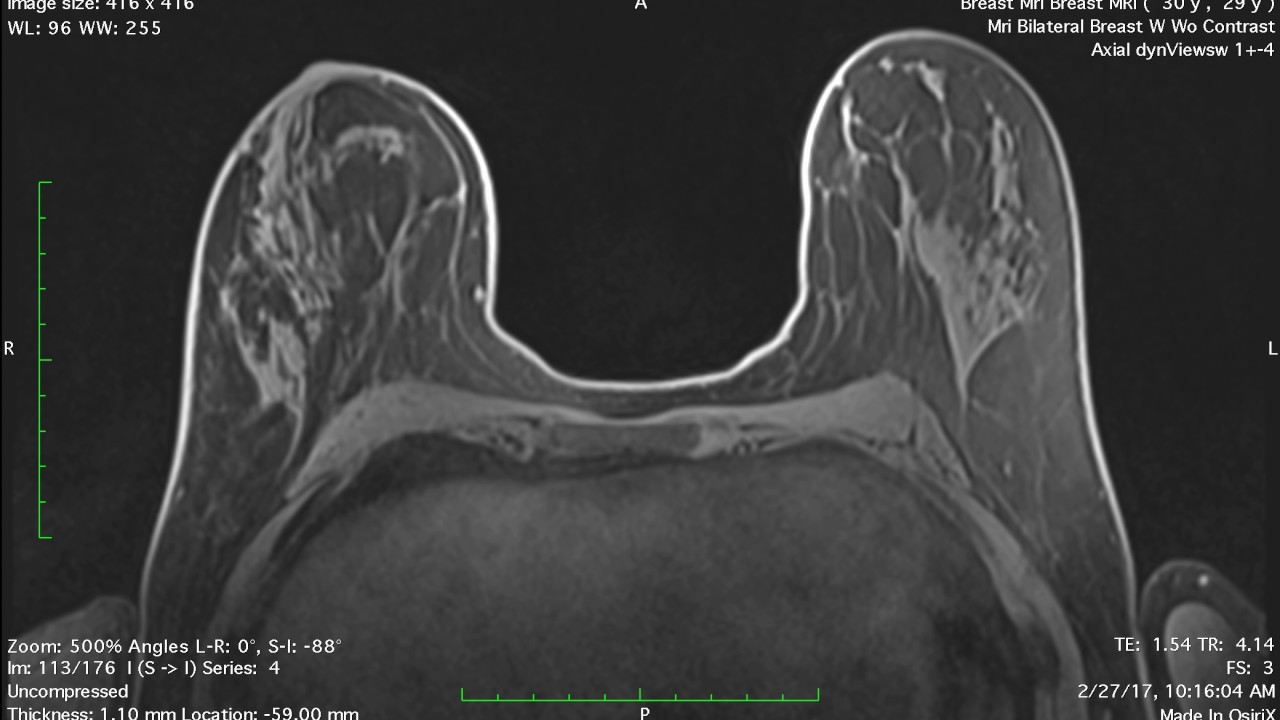 Breast Mri Fat Sat Pre con - YouTube