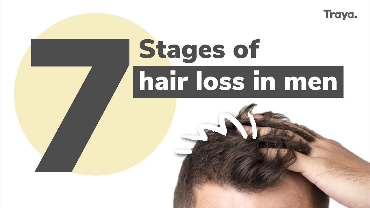 7 Stages of Hair Loss in Men | Right Time to Start the Treatment | Hair ...