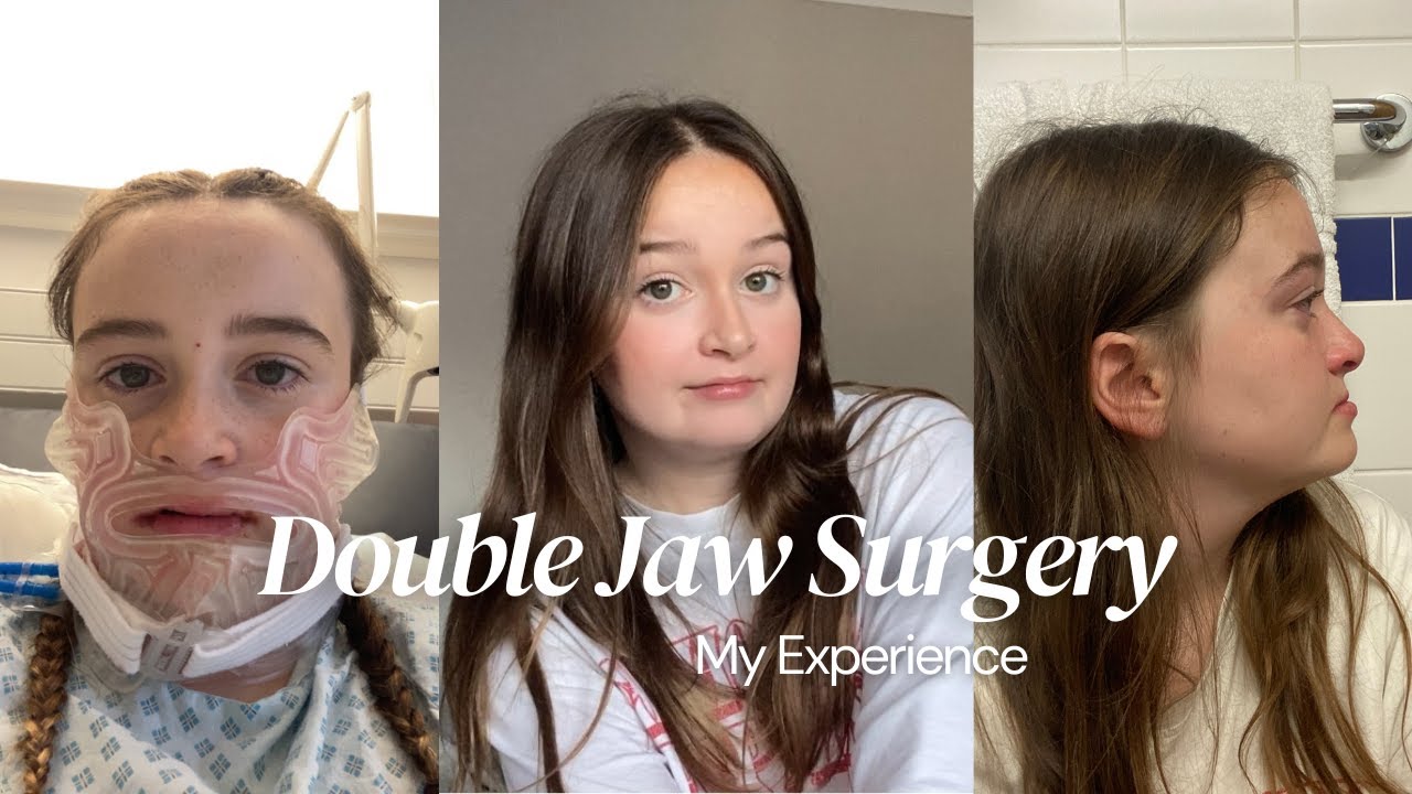 My double jaw surgery experience - YouTube
