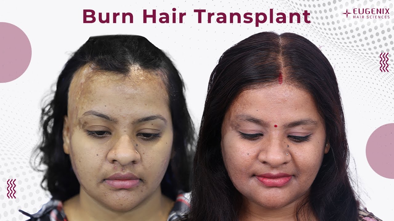 Will Burnt Hair Grow Back