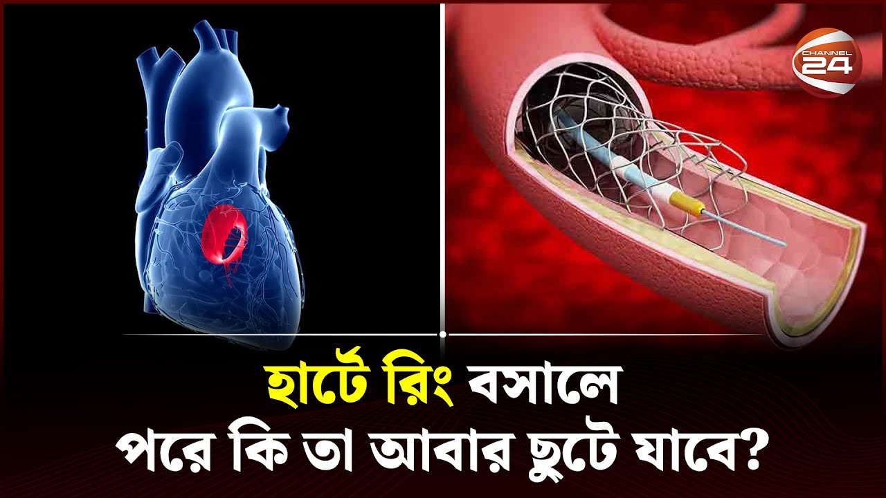 একবার হার্টে রিং বসালে পরে কি সমস্যা হতে পারে? | Heart Ring Surgery ...