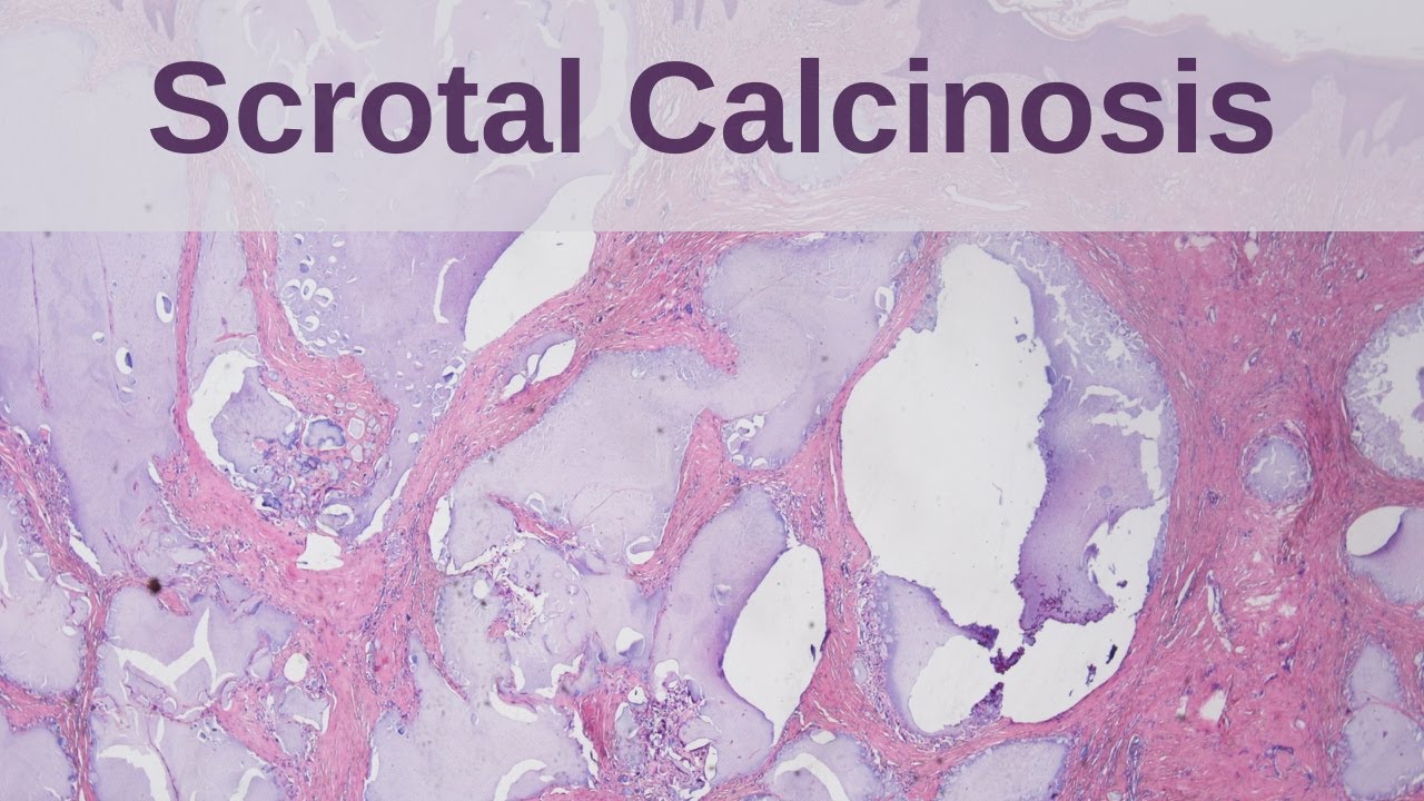 Scrotal Calcinosis Pathology Mini Tutorial Youtube