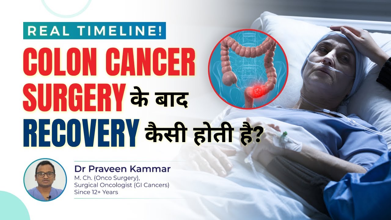 Colon Cancer Surgery के बाद recovery कैसी होती है? | Left Hemicolectomy ...