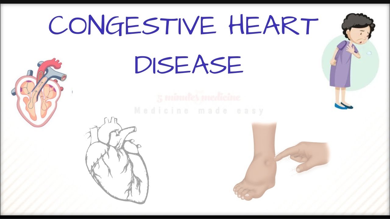 Congestive Heart Disease Definition Risk Factors Diagnosis congestive-heart-disease-definition-risk-factors-diagnosis