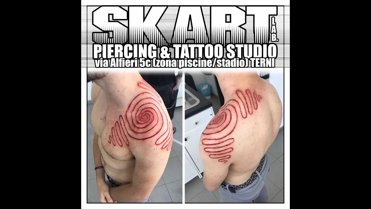 Cutting scarification procedure - SKART Lab. TERNI - YouTube