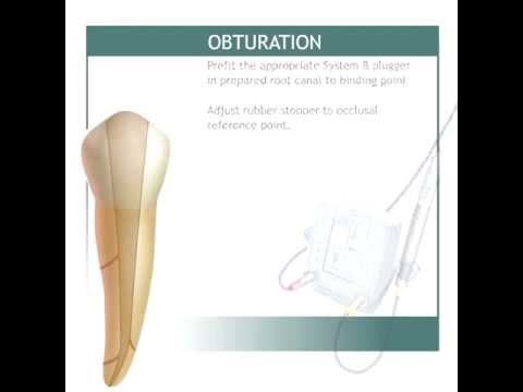 Continuous Wave Of Condensation Elements Obturation System - YouTube