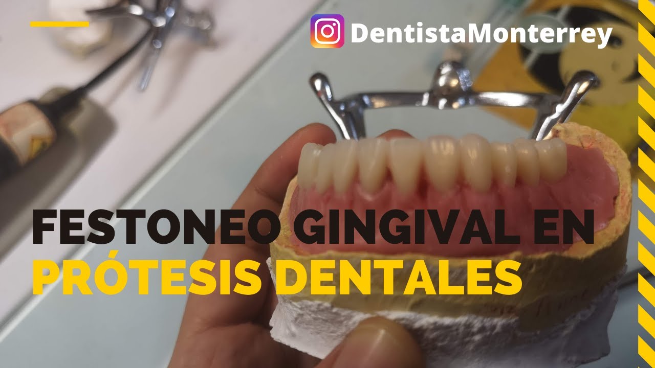 FESTONEO GINGIVAL 👅Prótesis Dental Inferior Parte3 #ProtesisDentales ...