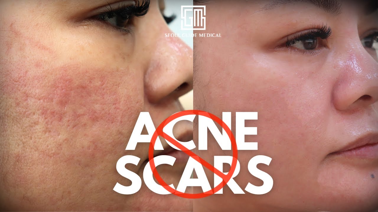 Treatment for Acne Scars & Large Pores | Seoul Guide Medical - YouTube
