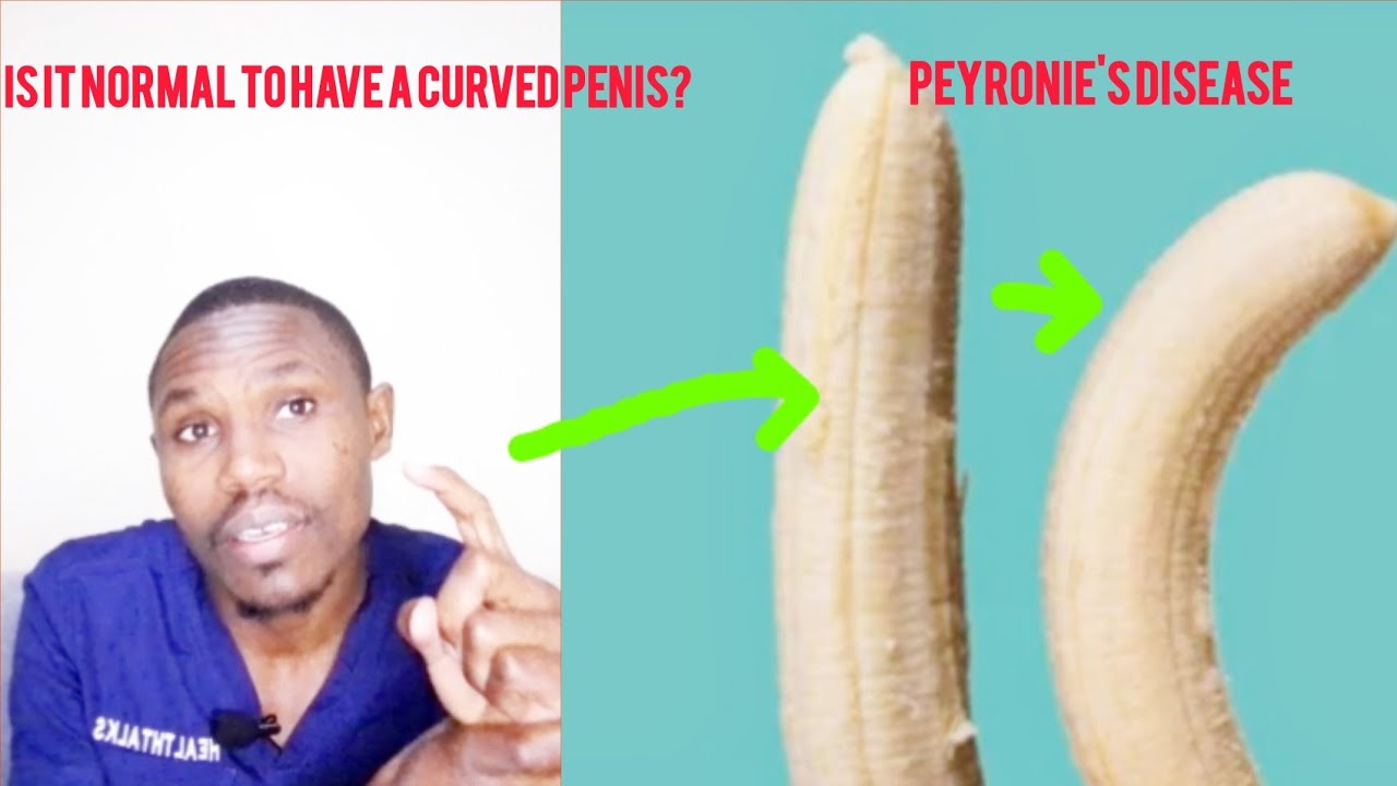 How To Fix A Curved Penispeyroniesdisease Youtube 8749