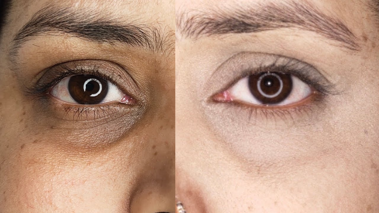 How To Remove Dark Circles Naturally At Home Quickly YouTube how-to-remove-dark-circles-naturally-at-home-quickly-youtube