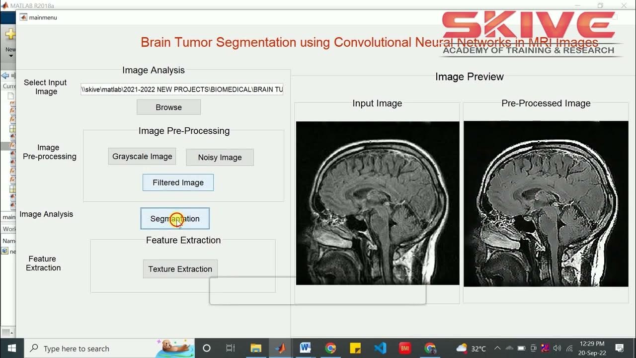 Brain Tumor Area Detection and Classification Using CNN | Matlab ...