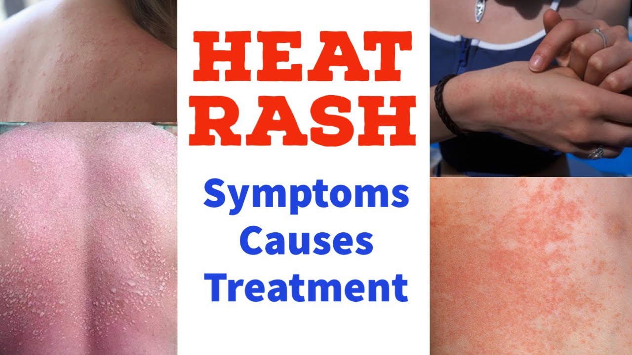 How To Treat Heat Rash YouTube