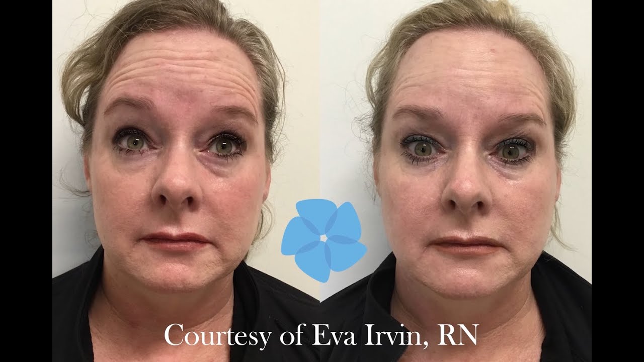 Neurotoxin Treatment Nashville Injector Youtube