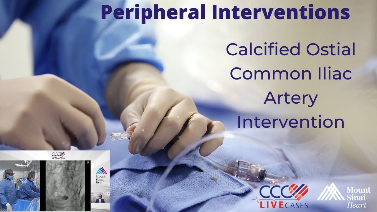 Calcified Ostial Common Iliac Artery Intervention - Peripheral ...