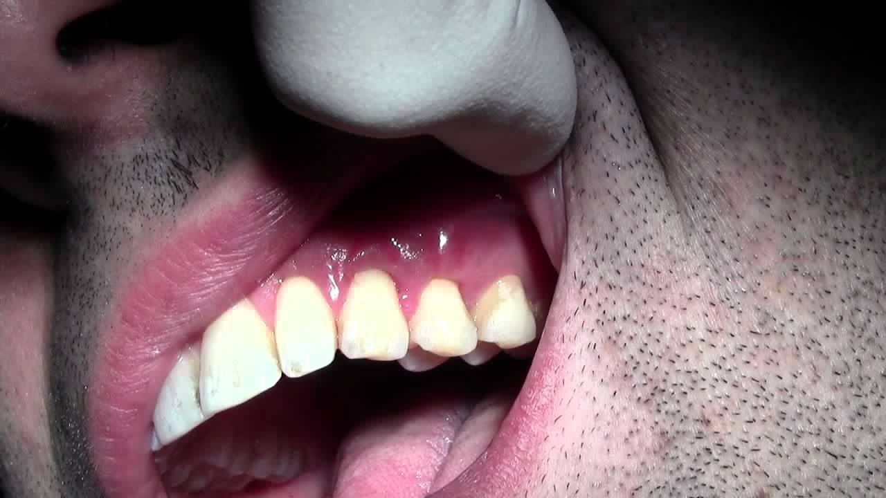 Alloderm Gingival Grafting 11 12 Sites 4 Week Post op YouTube alloderm-gingival-grafting-11-12-sites-4-week-post-op-youtube