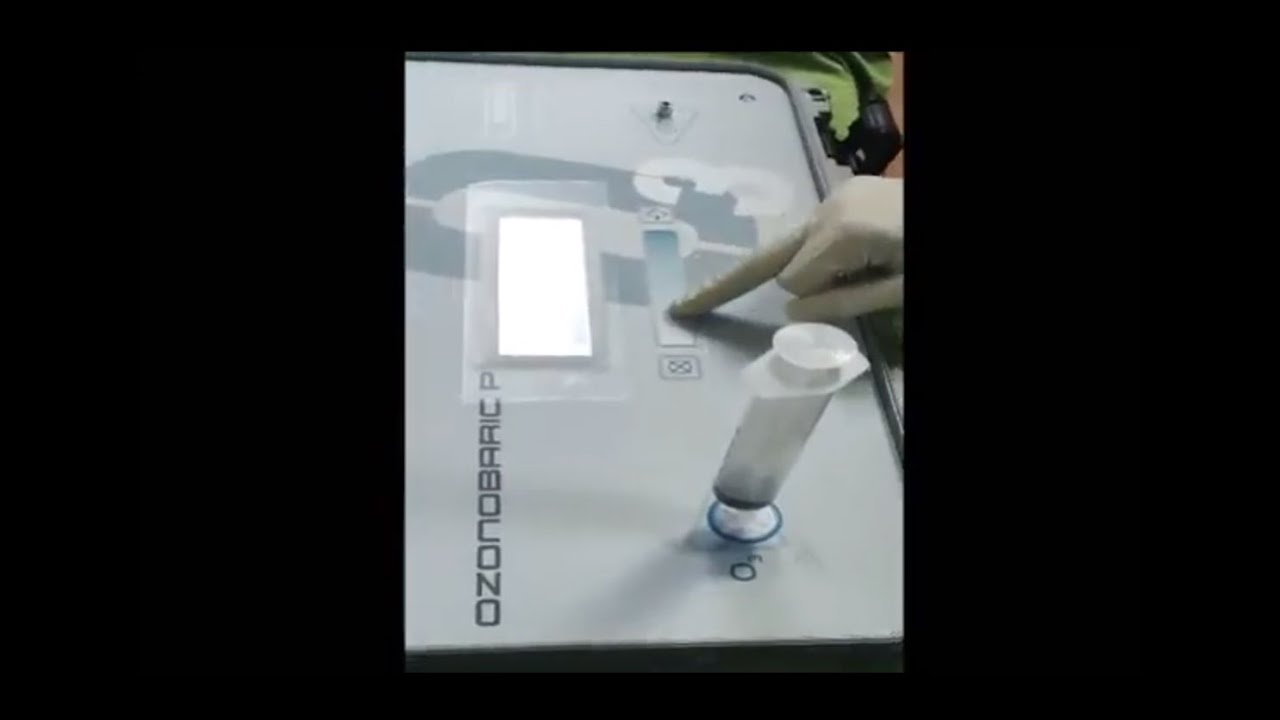 Ozone Therapy Live Successful Procedure By Dr.Yousuf Memon - YouTube