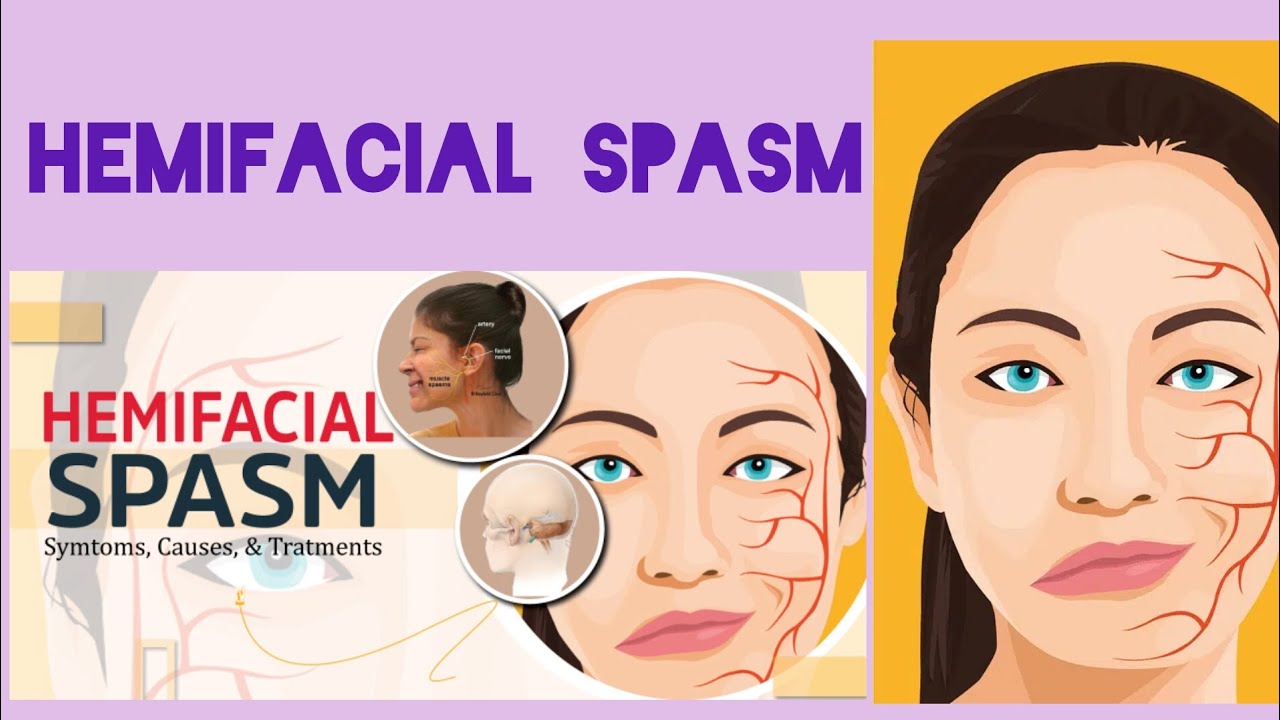 Hemifacial spasm #plz_subscribe_my_channel #nursingexamquestions # ...