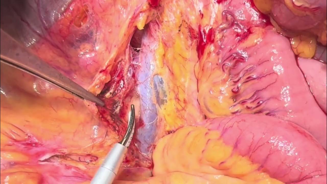 Extended Right Hemicolectomy with CVL, CME, D3 Lymph node dissection - YouTube