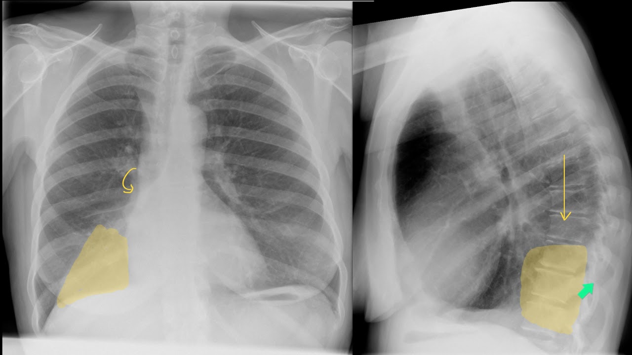 Right Upper Lobe Collapse - YouTube