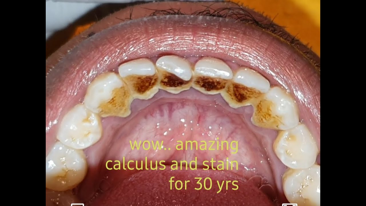 wow.. Amazing Calculus and Stain almost 30 years. - YouTube
