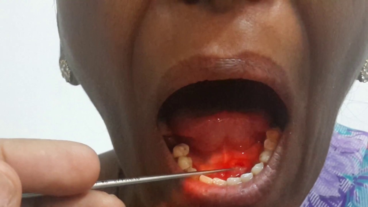 Sub mandibular Gland..Whartons duct - YouTube