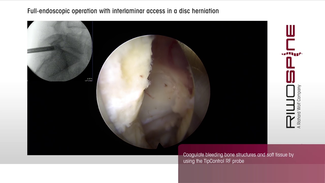 RIWOspine Full-endoscopic Spine Surgery at Lumbar Spine - interlaminar ...