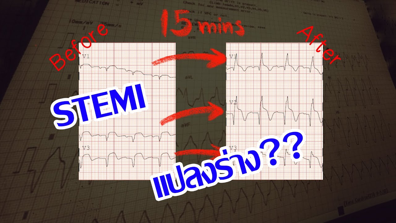 STEMI with intermittent BBB นี่คือสัญญาณอันตราย | EKG Reading Tips ...