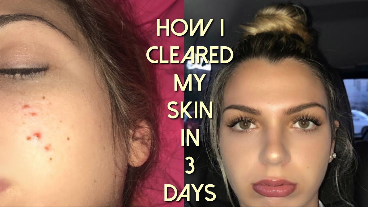 How I Cleared My Skin Fast Youtube