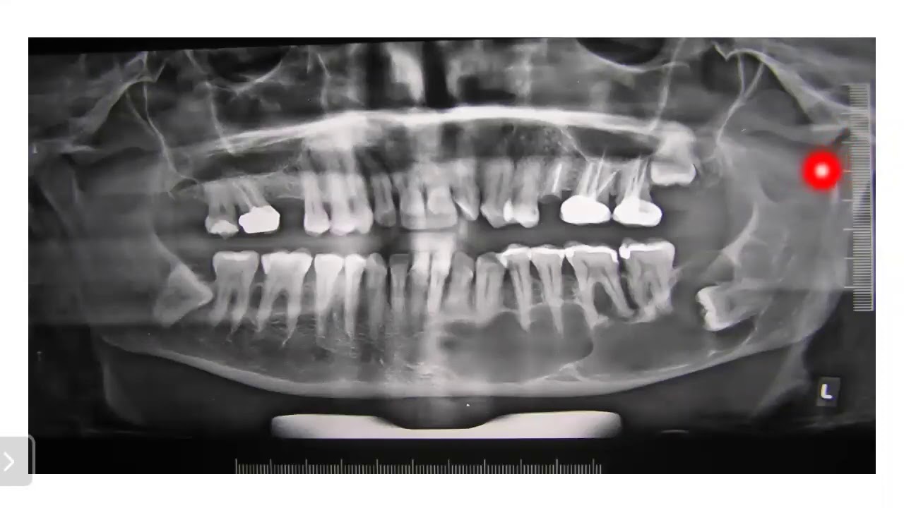 Radiographs in OMFS - YouTube