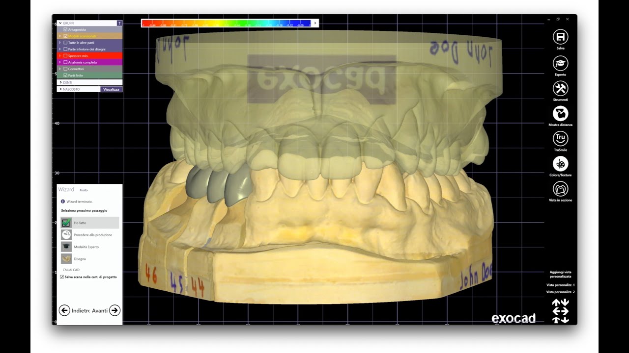 Exocad 10 minutes guide - Three element bridge - Ponte anatomico di tre ...