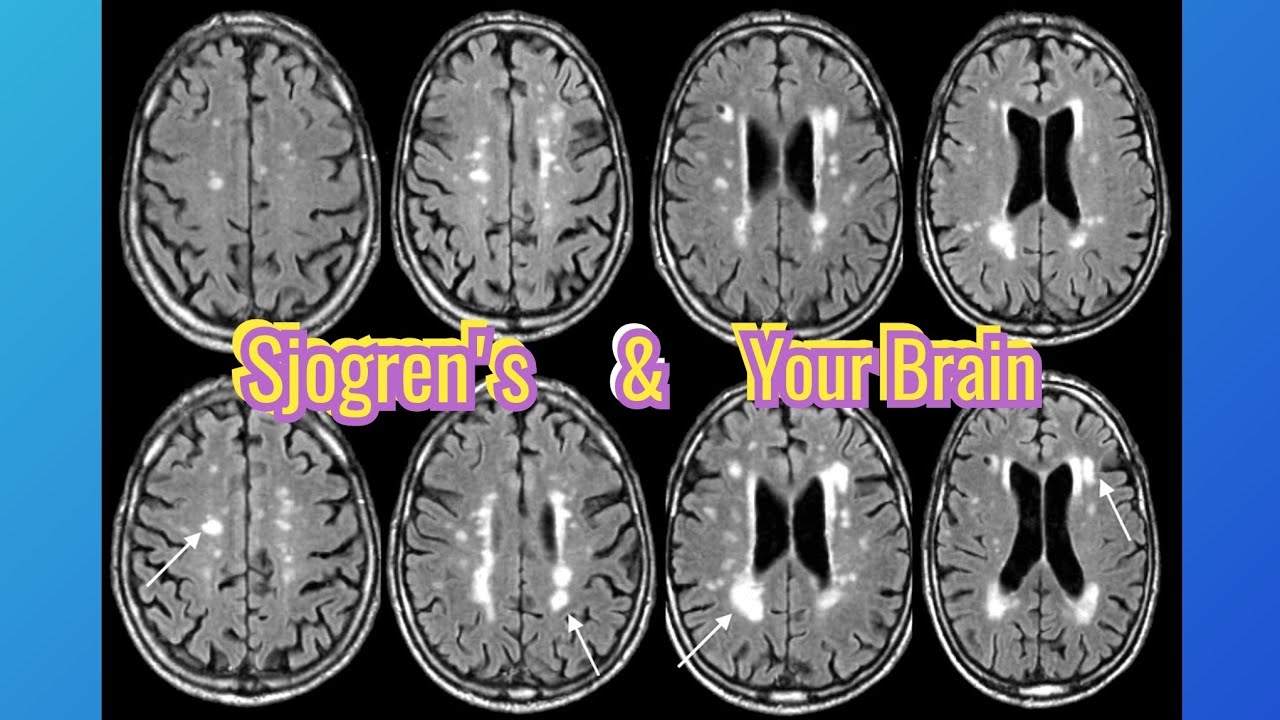 Autoimmune Brain Leisions, My Sjogren's Symptoms, Part 5 - YouTube