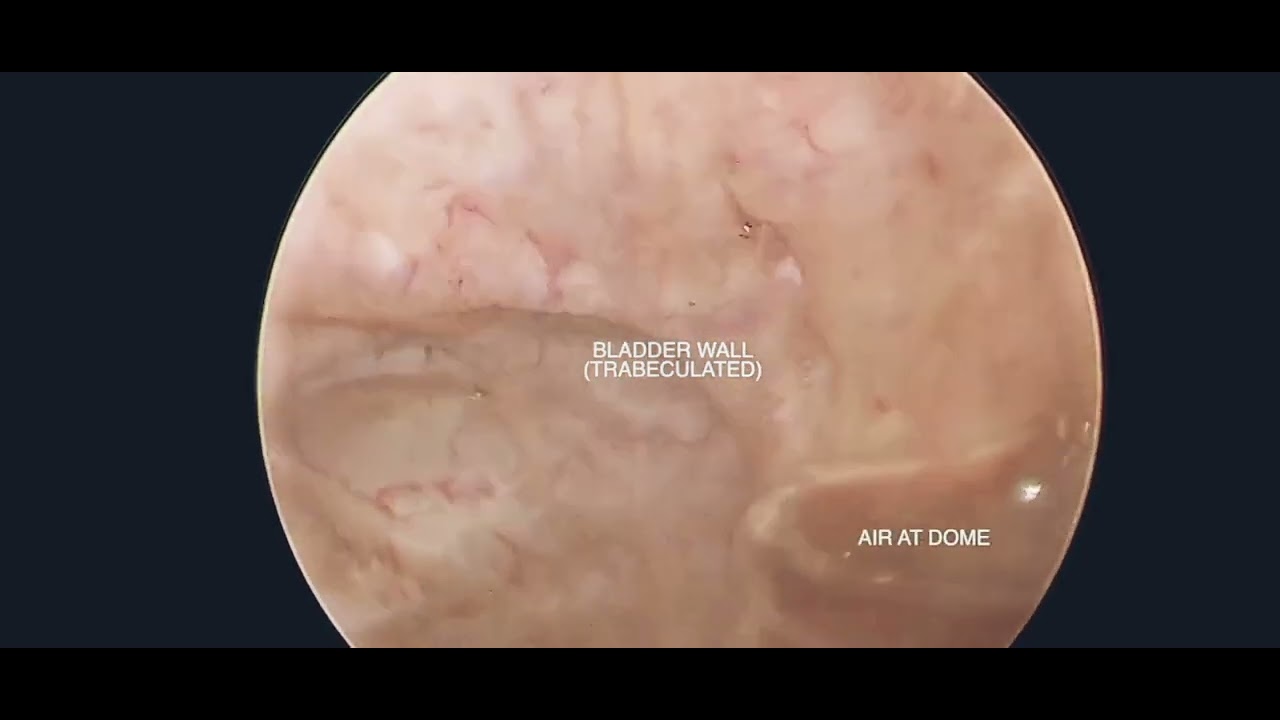 Male Cystoscopy #bladder - YouTube