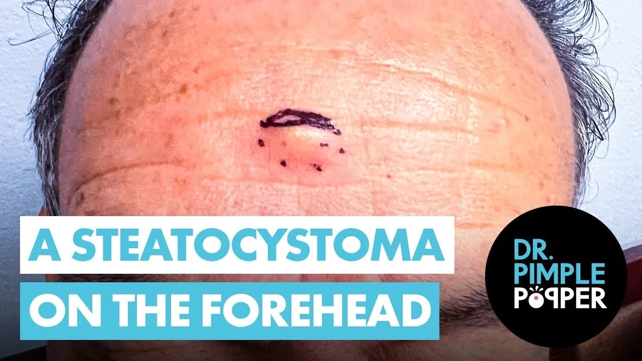 A Forehead Steatocystoma with a BONUS | Dr. Pimple Popper - YouTube
