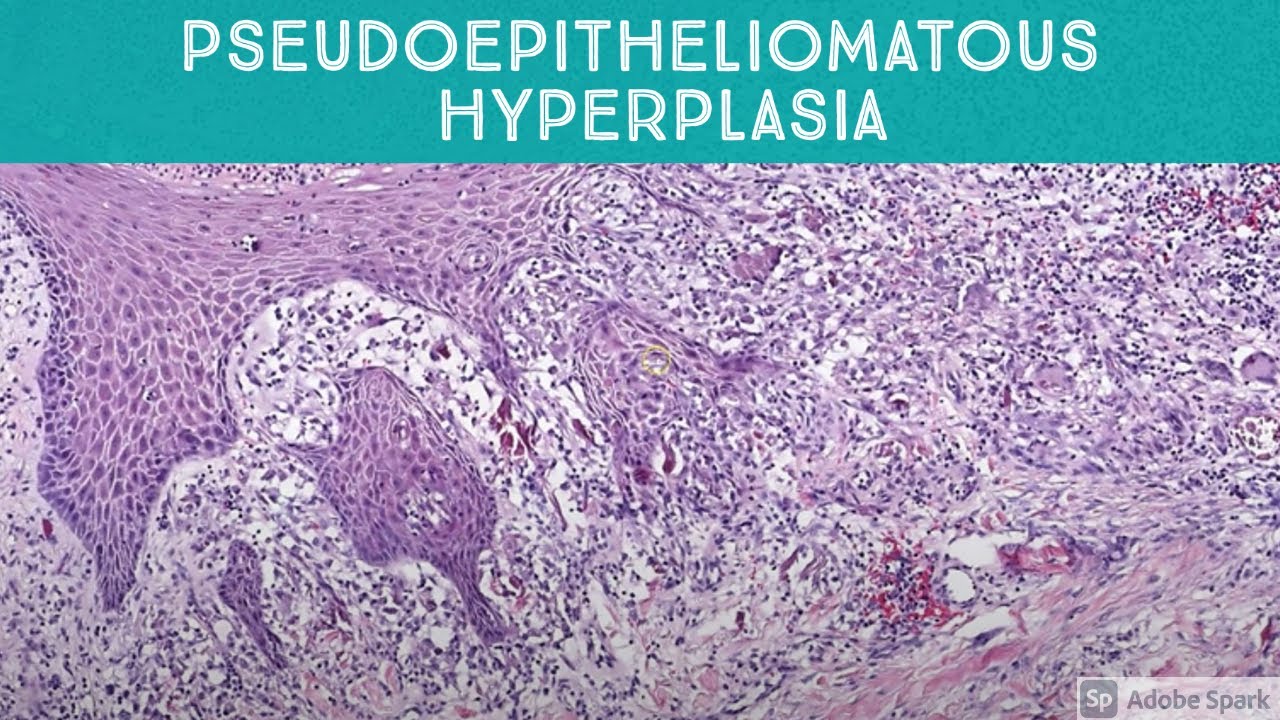 Pseudoepitheliomatous Hyperplasia PEH A Reactive Mimic Of Squamous pseudoepitheliomatous-hyperplasia-peh-a-reactive-mimic-of-squamous