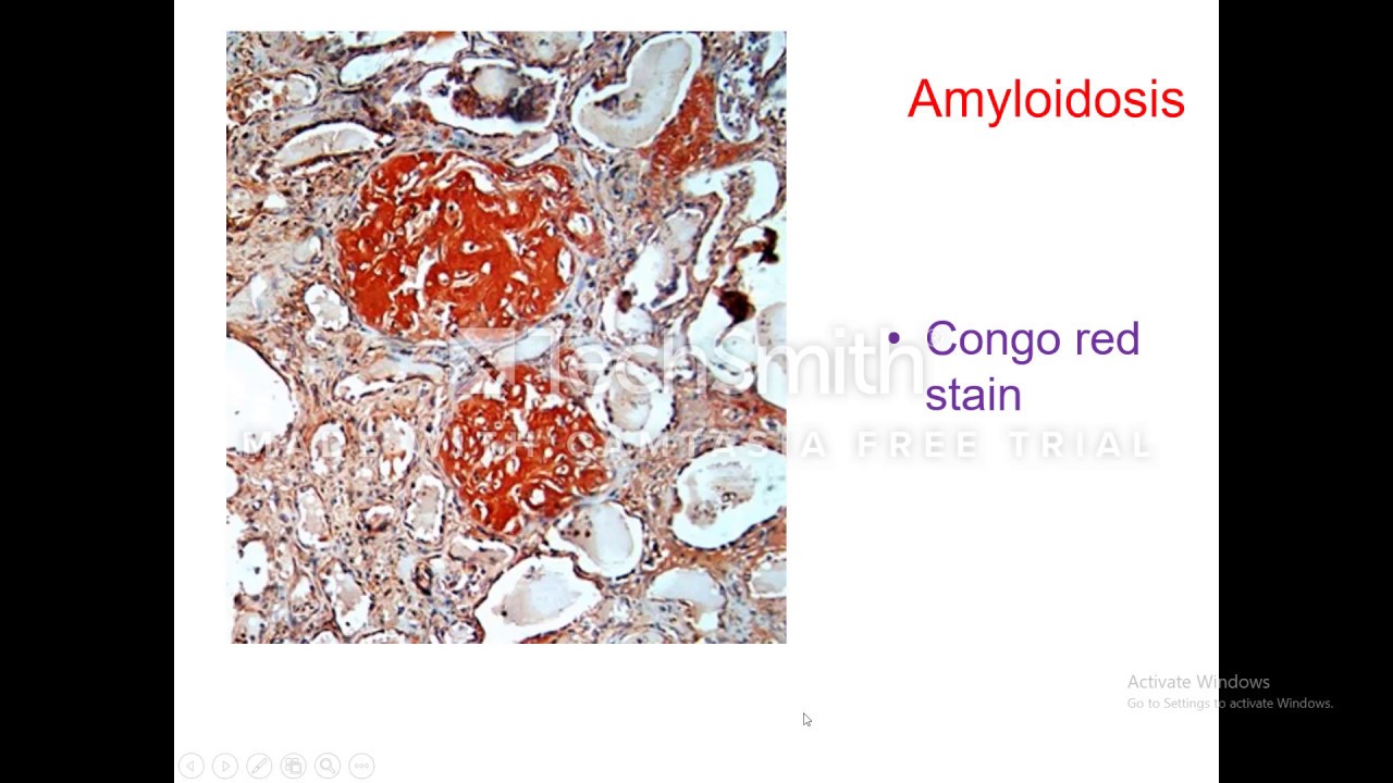 Amyloidosis : Definition, Physical nature and Chemical nature of Amyloidosis - YouTube