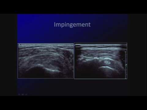 Sonography of Common Shoulder and Elbow Pathology - YouTube