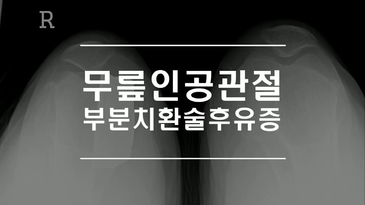 무릎인공관절 후 무릎이 빠진다? feat. UKA bearing dislocation! - YouTube