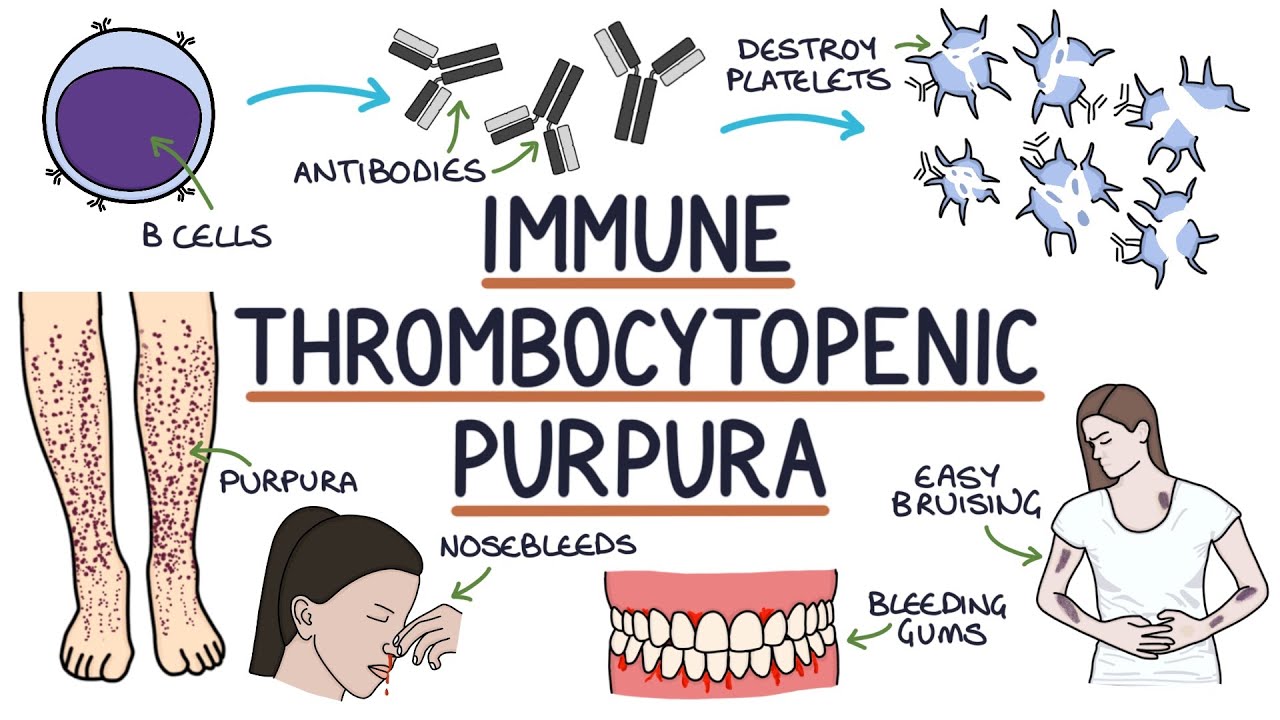 Immune Thrombocytopenic Purpura - YouTube