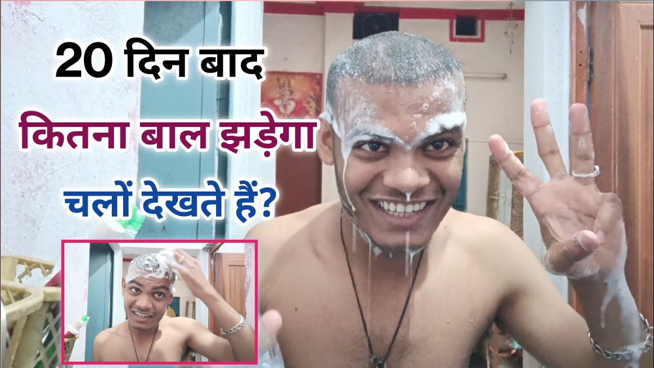 Hair Transplant Second Head Wash After Hair Transplant Bhopal City ...