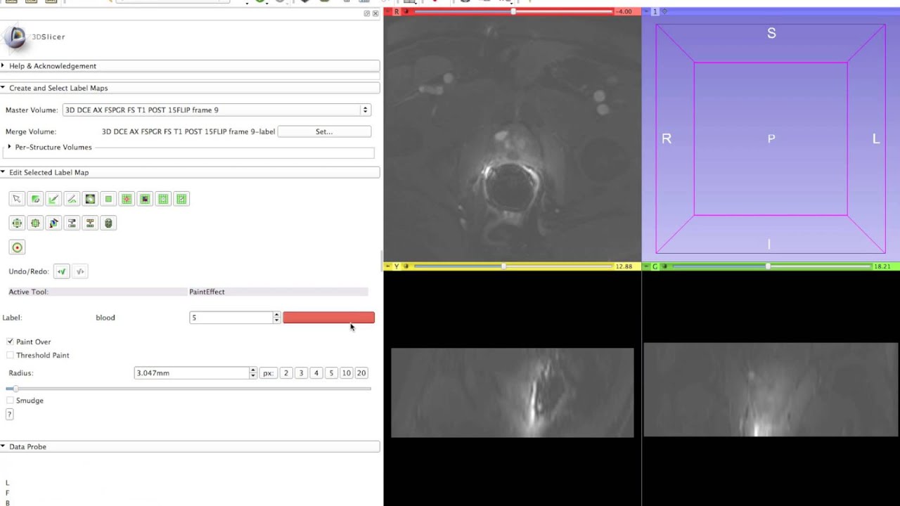 3D Slicer: MultiVolume support demo - YouTube