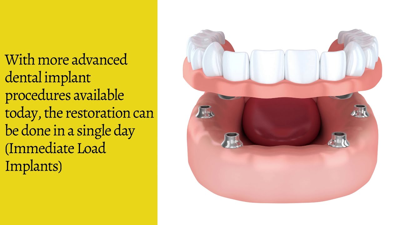 Step by Step Implant procedure and timeline - YouTube