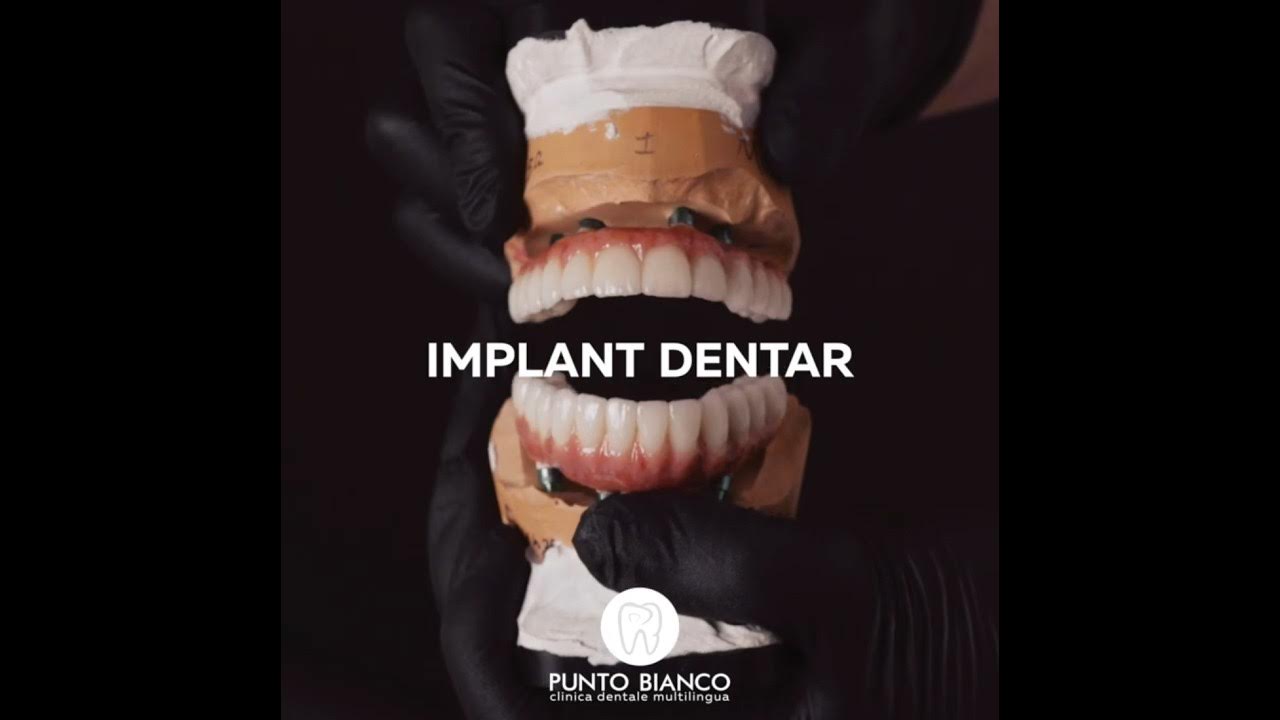 Tu De Care Implant Dentar Ai Nevoie Clinica Punto Bianco Chisinau tu-de-care-implant-dentar-ai-nevoie-clinica-punto-bianco-chisinau